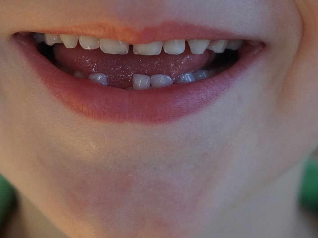 How Will I Know When My Child's Baby Teeth Will Fall Out?